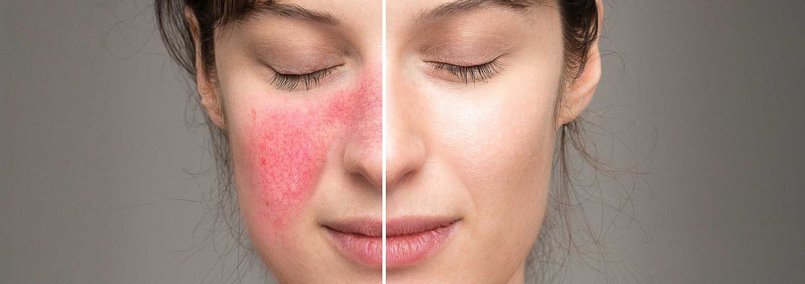 Traitement veinules par radiofréquence - Biomed Paris Paris